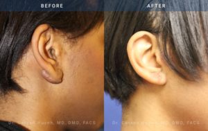 Ear Surgery Atlanta, GA | Otoplasty | Radiance Surgery and Aesthetic ...