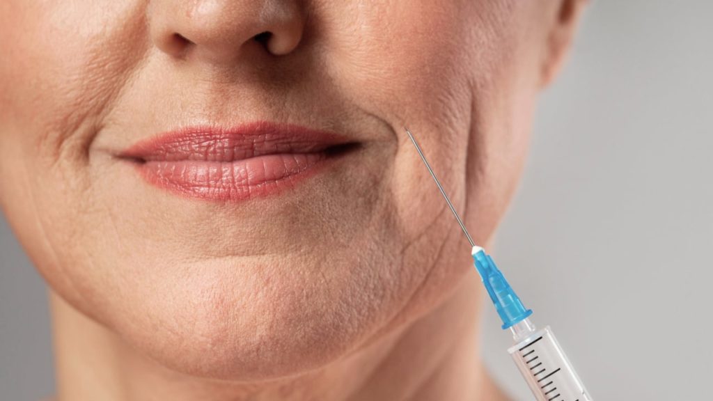 The Complete Guide To Lip Lifts | Discover Radiance