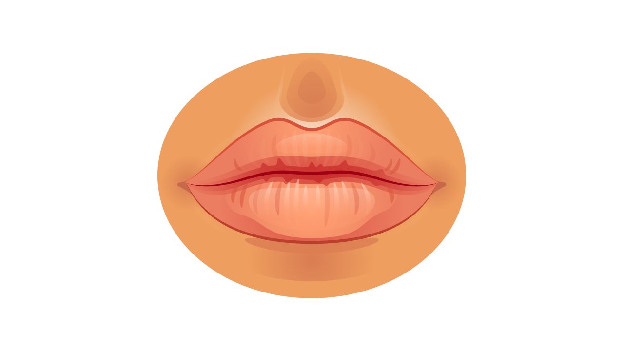 The Complete Guide To Lip Lifts | Discover Radiance