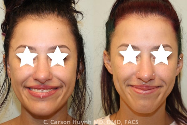 Dimpleplasty Archives - Radiance Surgery & Aesthetic Medicine