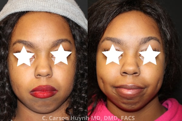 Dimpleplasty Archives - Radiance Surgery & Aesthetic Medicine