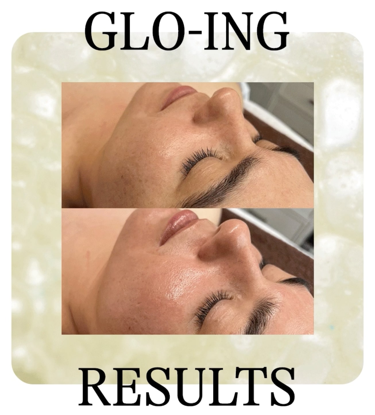 Glo2Facial in Atlanta, GA | Radiance Surgery & Aesthetic Medicine